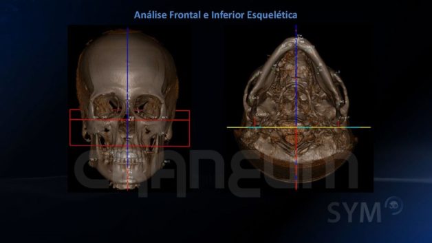 Tomografias - Craneum