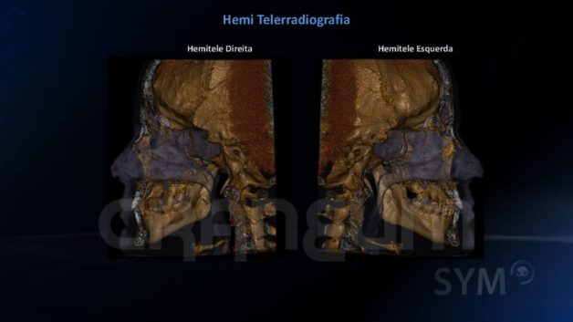 Tomografias - Craneum
