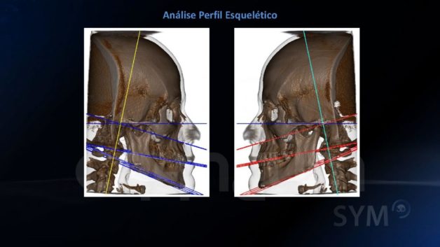 Tomografias - Craneum