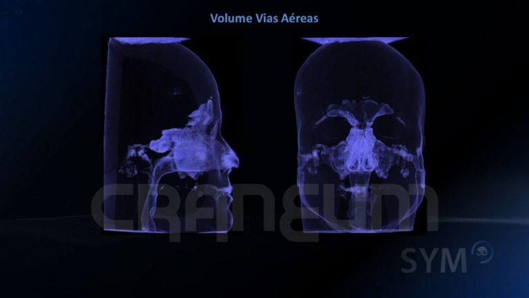Tomografias - Craneum